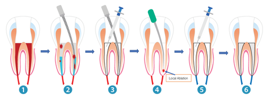 FOR IMMEDIATE RELEASE: AMD Lasers to Introduce Breakthrough Laser Root ...